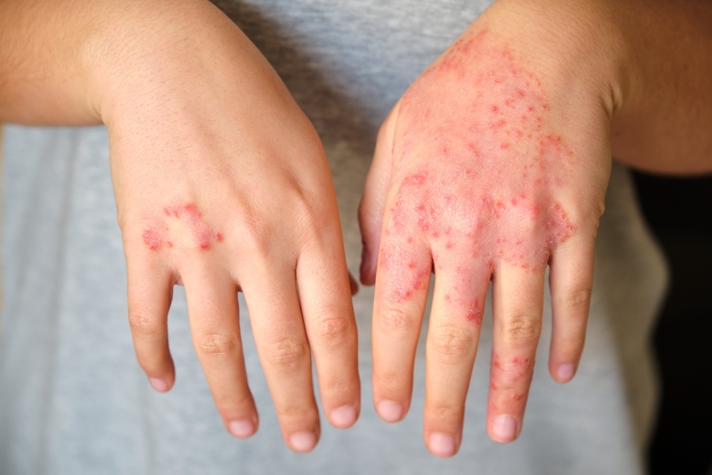Tratamento da dermatite atópica: quais as opções de tratamentos?